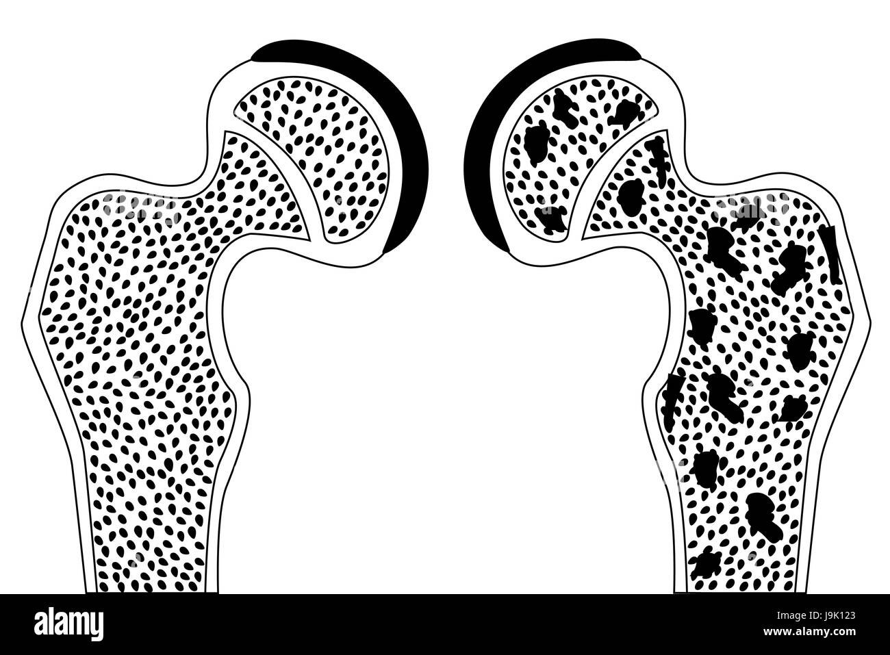 Ossa spugnose immagini e fotografie stock ad alta risoluzione - Alamy