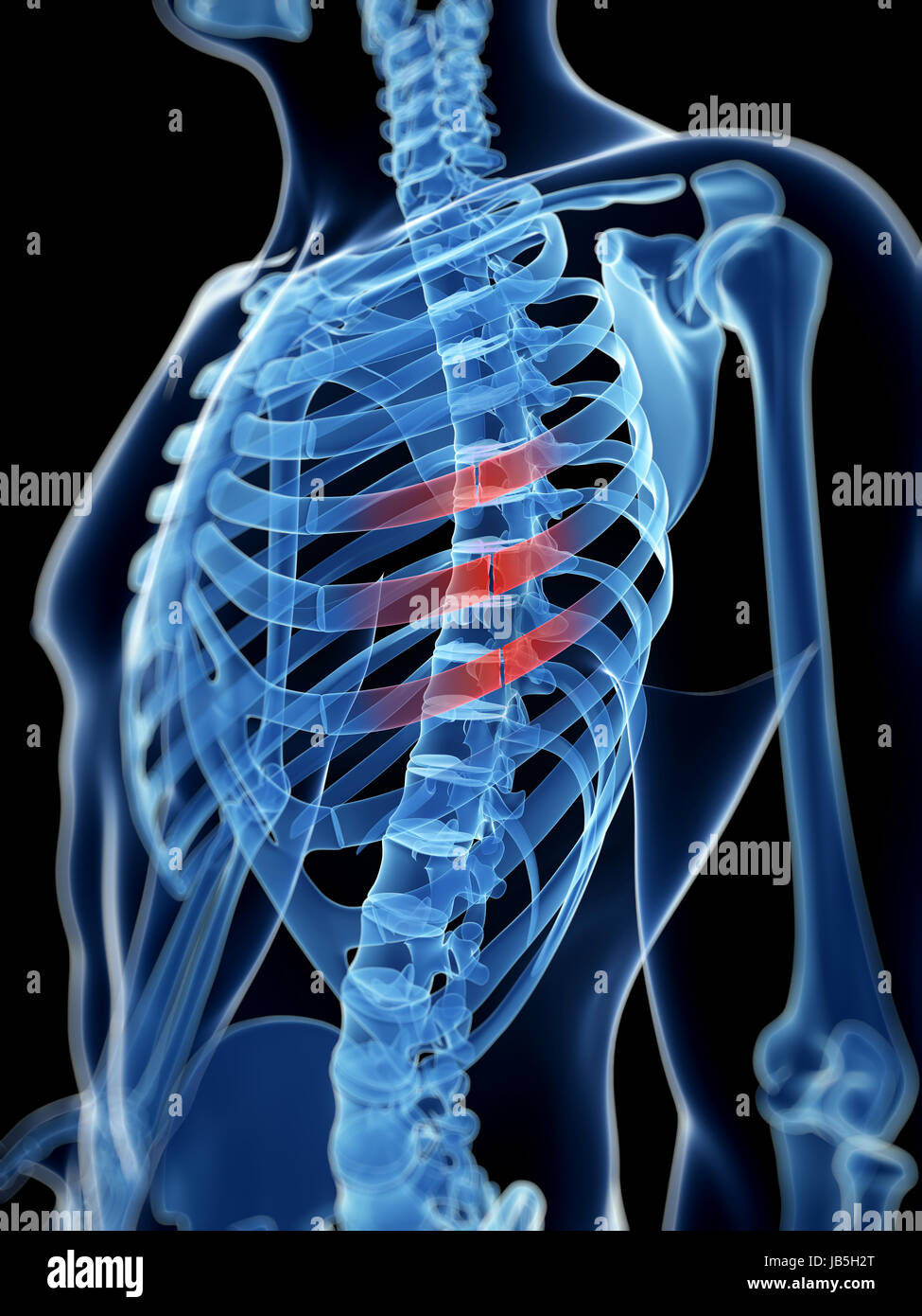 Illustrazione medica di costole rotte Foto stock - Alamy