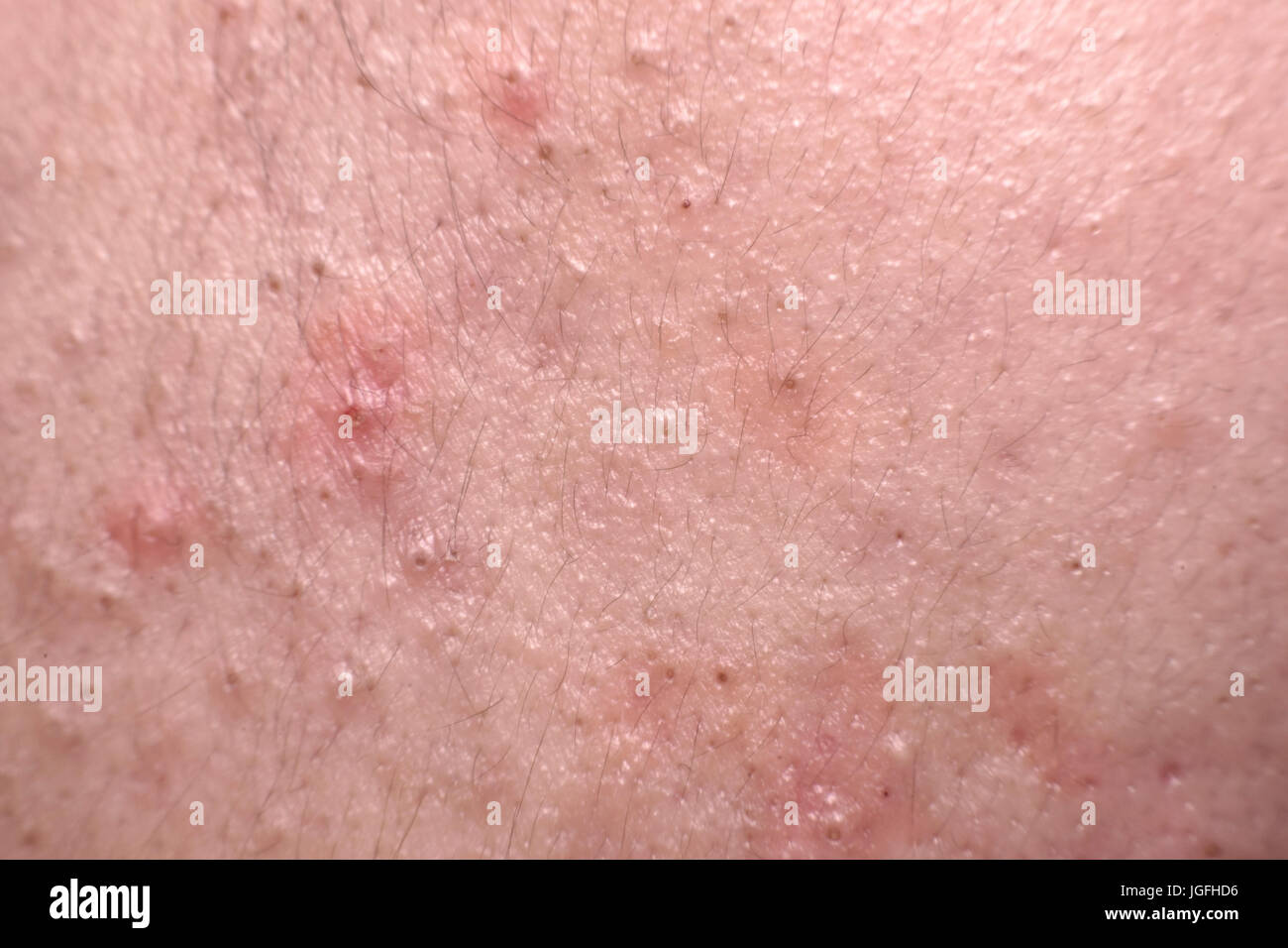 Disturbi dermatologici immagini e fotografie stock ad alta risoluzione ...