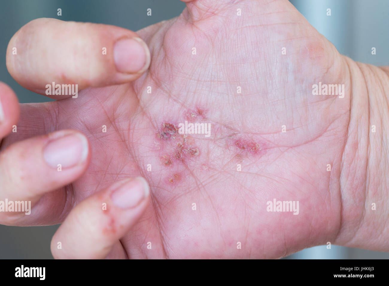 Dermatite da contatto immagini e fotografie stock ad alta risoluzione ...