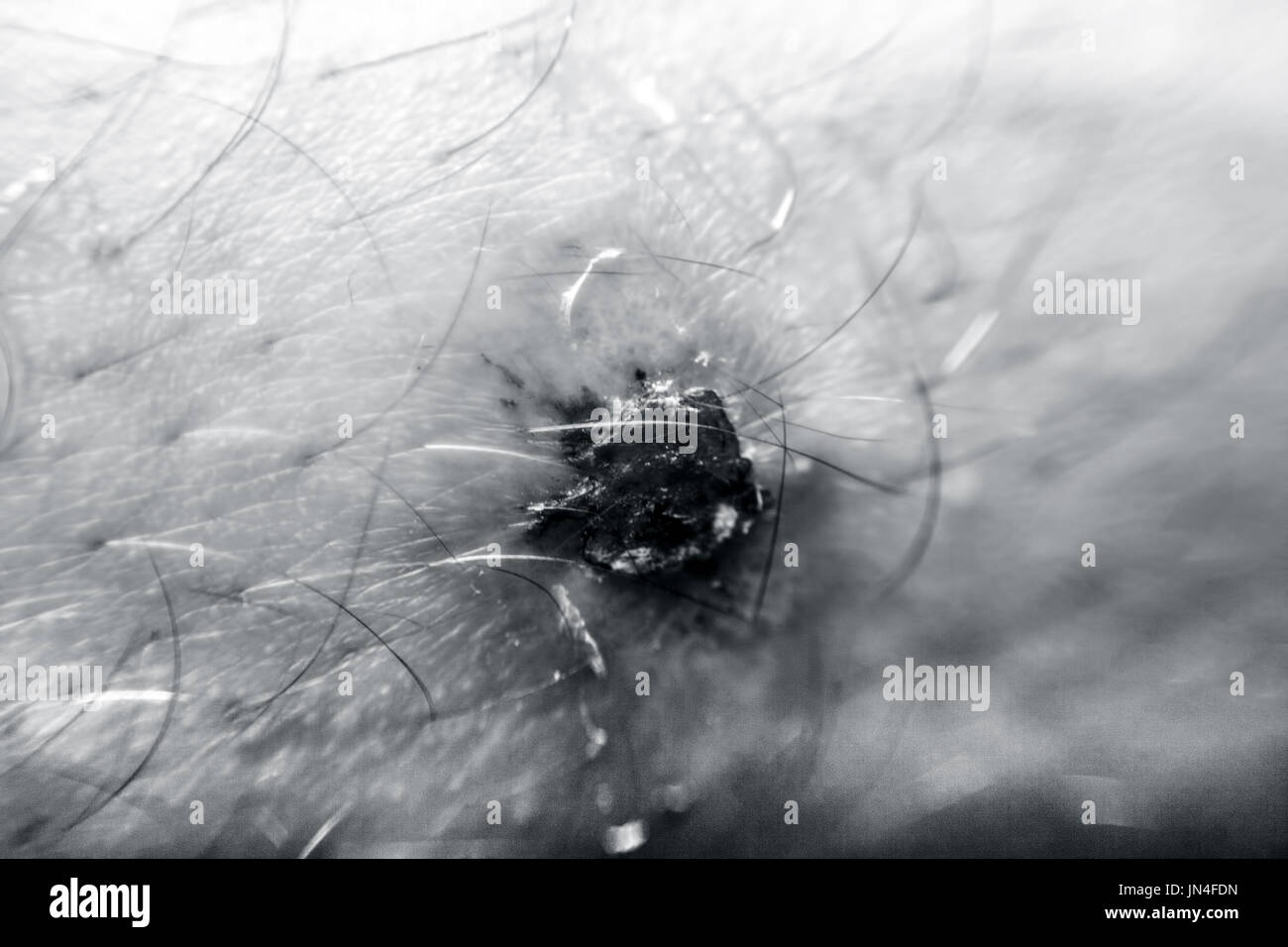 Cisti sebacea immagini e fotografie stock ad alta risoluzione - Alamy