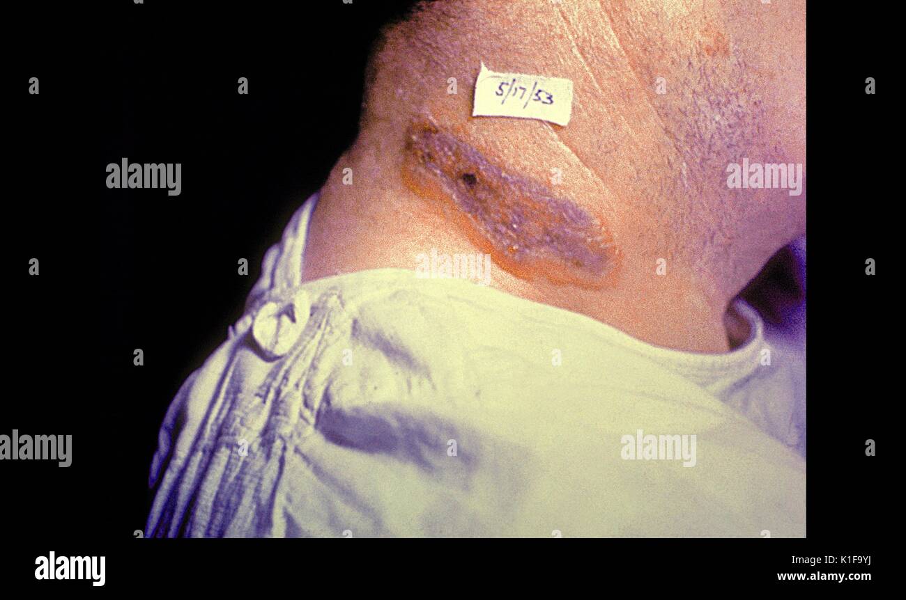 Lesione cutanea immagini e fotografie stock ad alta risoluzione - Alamy