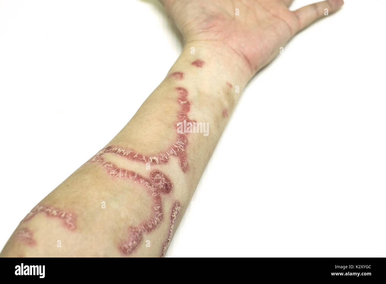 Placche di psoriasi immagini e fotografie stock ad alta risoluzione - Alamy