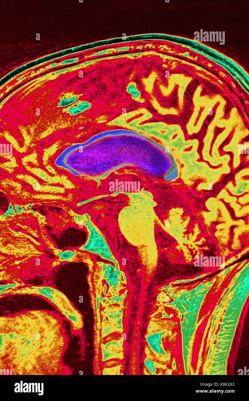 Atrofia cerebrale immagini e fotografie stock ad alta risoluzione - Alamy