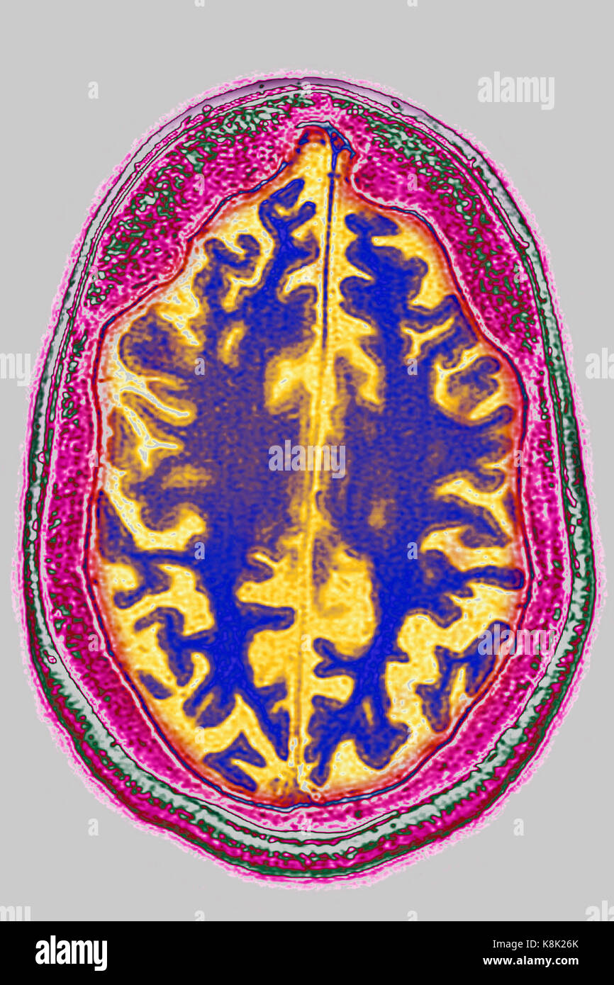 Atrofia cerebrale immagini e fotografie stock ad alta risoluzione - Alamy