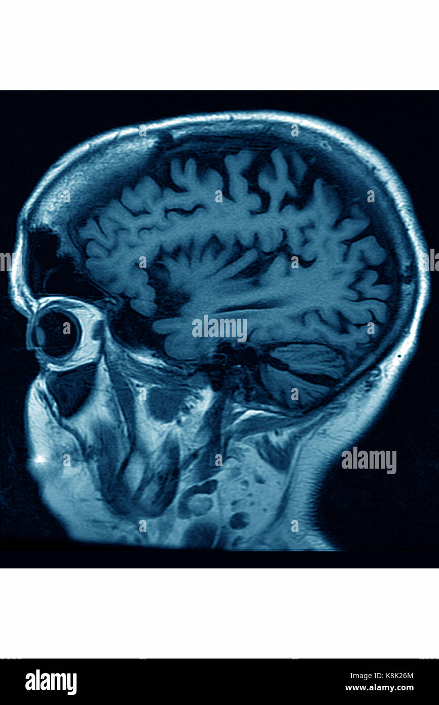 Mri di atrofia cerebrale immagini e fotografie stock ad alta ...