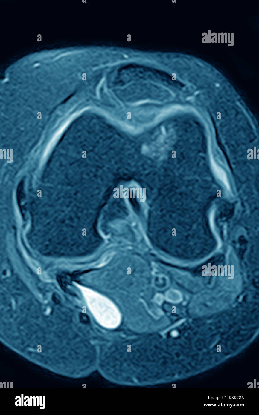 EDEMA OSSEO MRI Foto stock - Alamy
