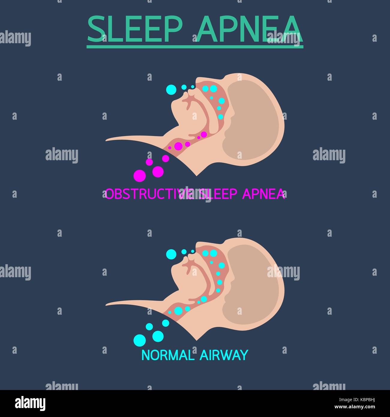 Obstructive sleep apnea Immagini Vettoriali Stock - Alamy
