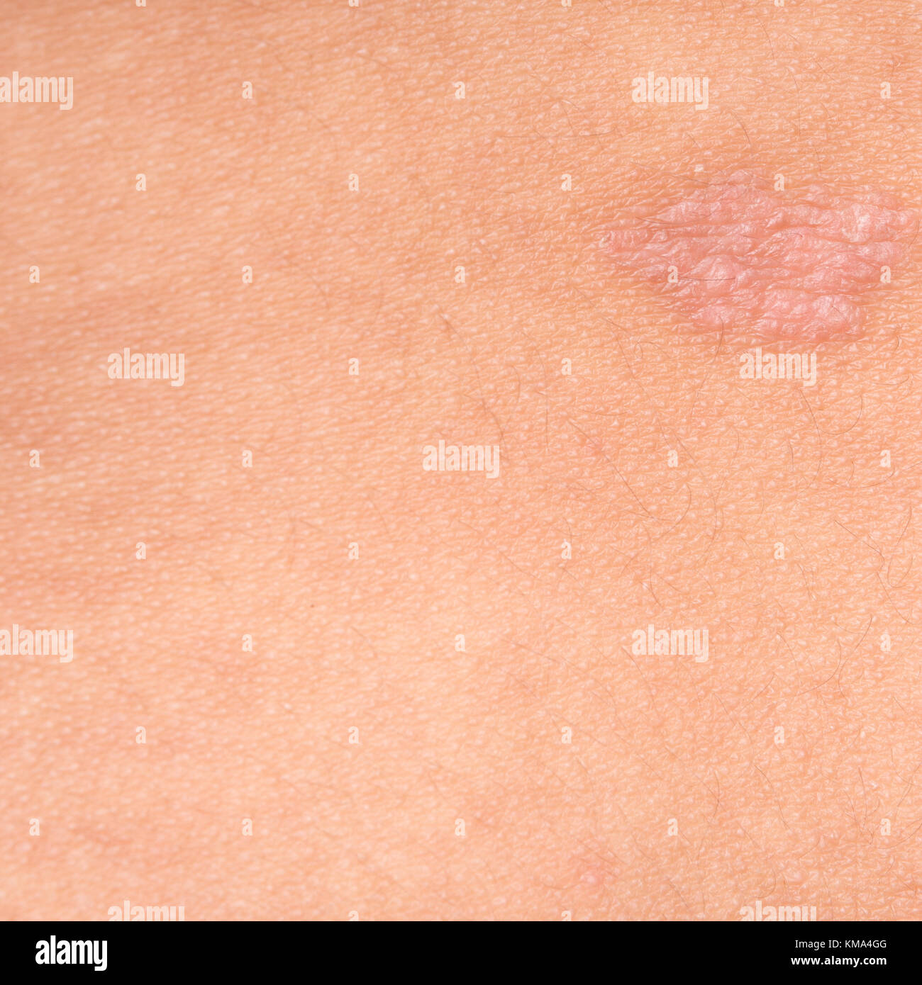 Psoriasi. La psoriasi è una malattia autoimmune che colpisce la pelle ...