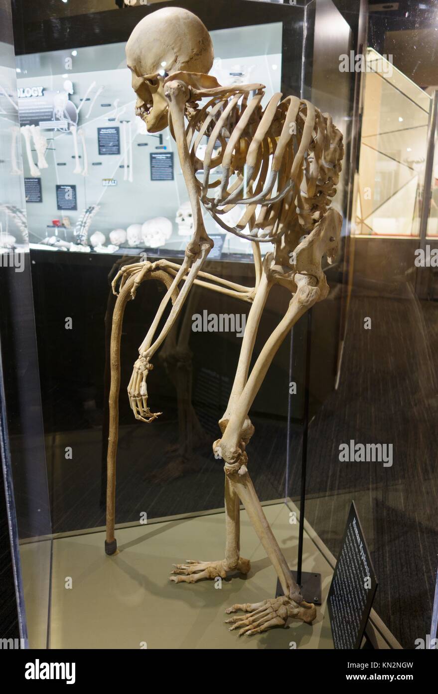 Lo scheletro di un uomo con un gobbo, presso il Museo di scheletri di ...