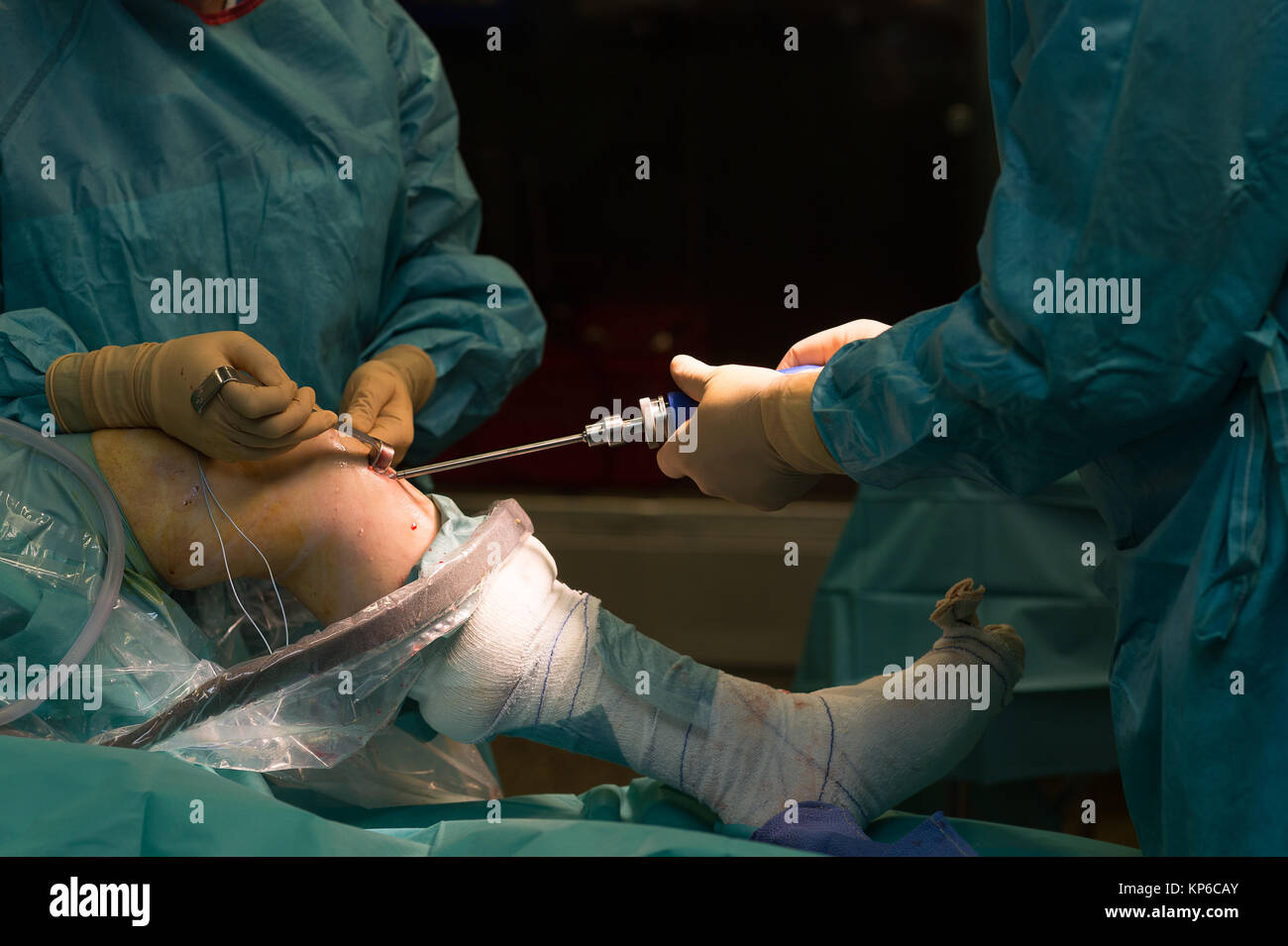 Leg screws immagini e fotografie stock ad alta risoluzione - Alamy