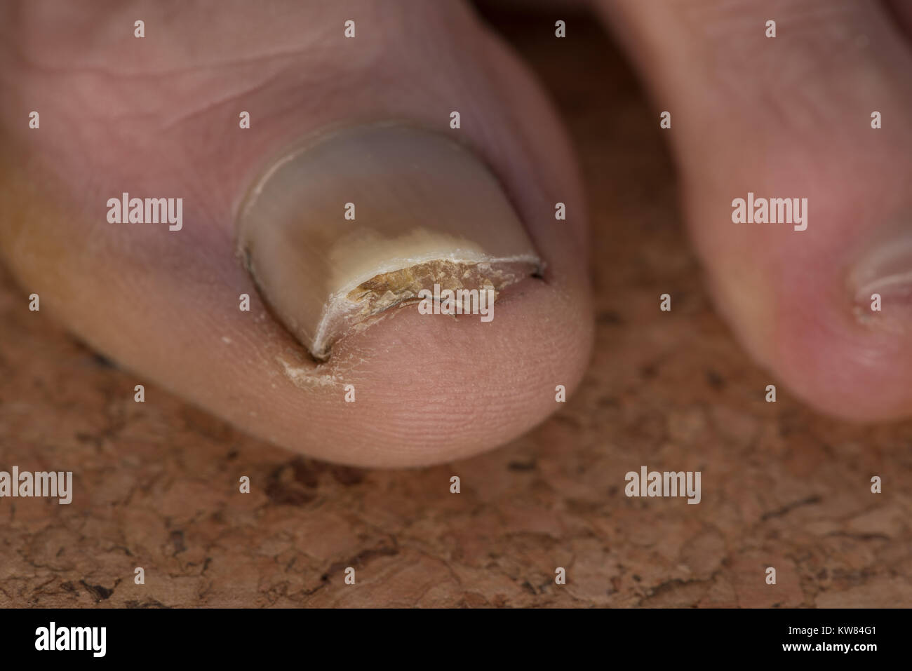 Infezione fungina delle unghie immagini e fotografie stock ad alta ...