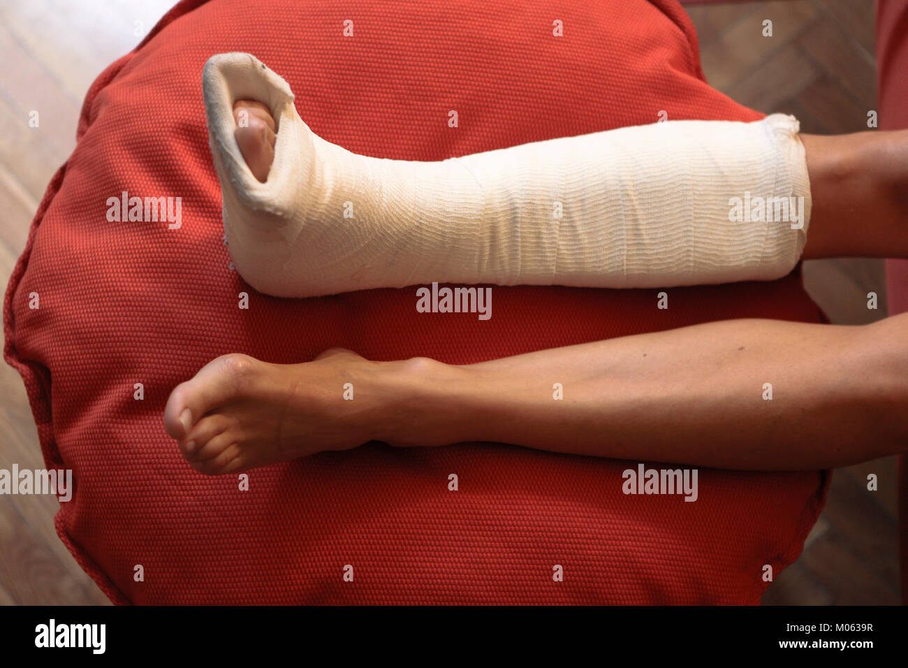 Gamba ingessata immagini e fotografie stock ad alta risoluzione - Alamy