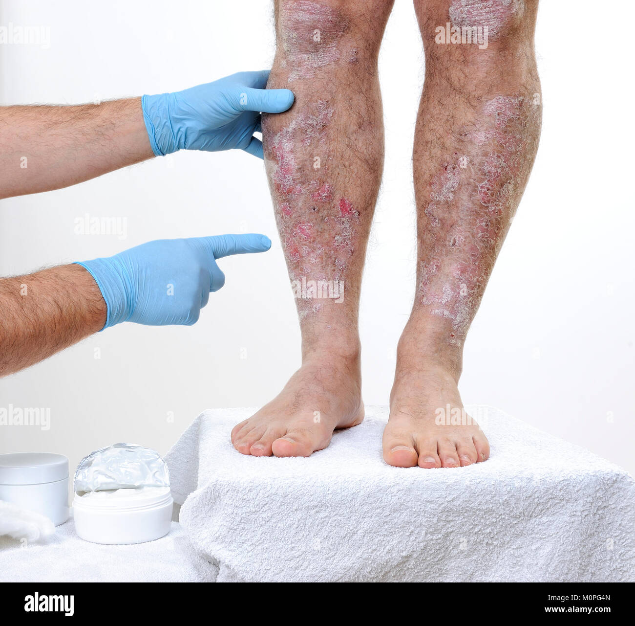 Placche di psoriasi immagini e fotografie stock ad alta risoluzione - Alamy