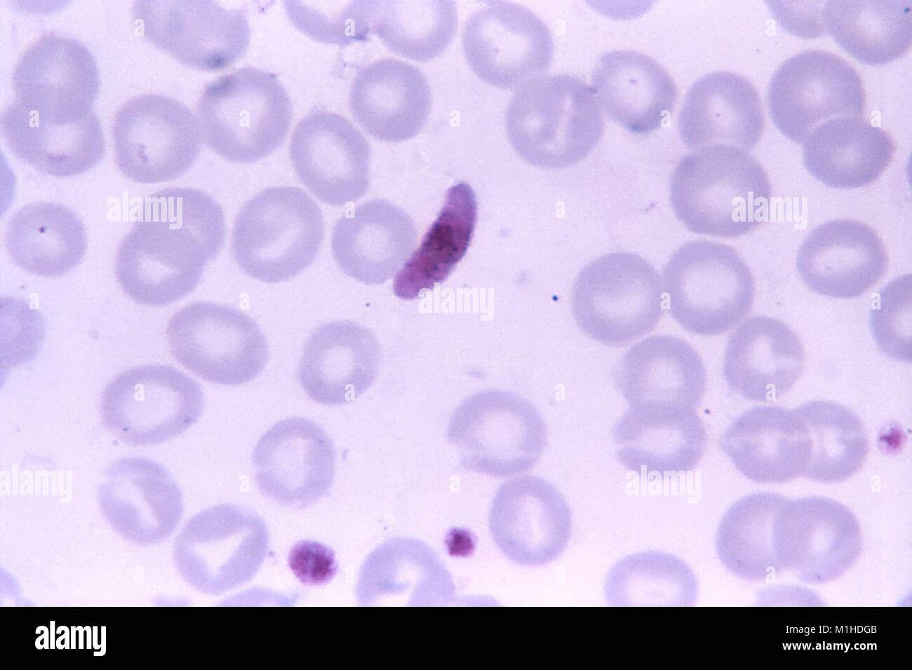 Striscio Spesso Di Parassita Della Malaria