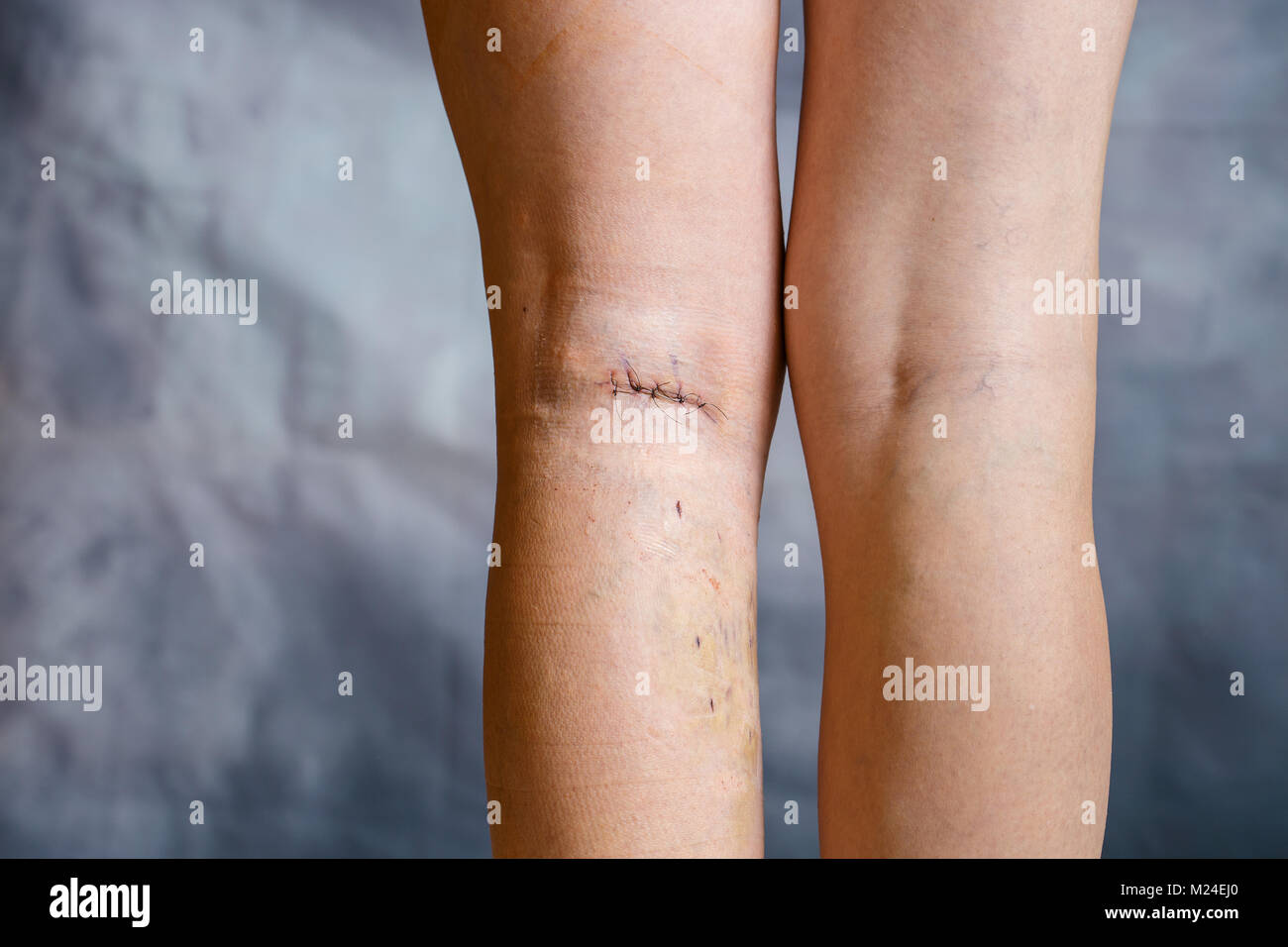 Trombosi delle vene delle gambe immagini e fotografie stock ad alta ...