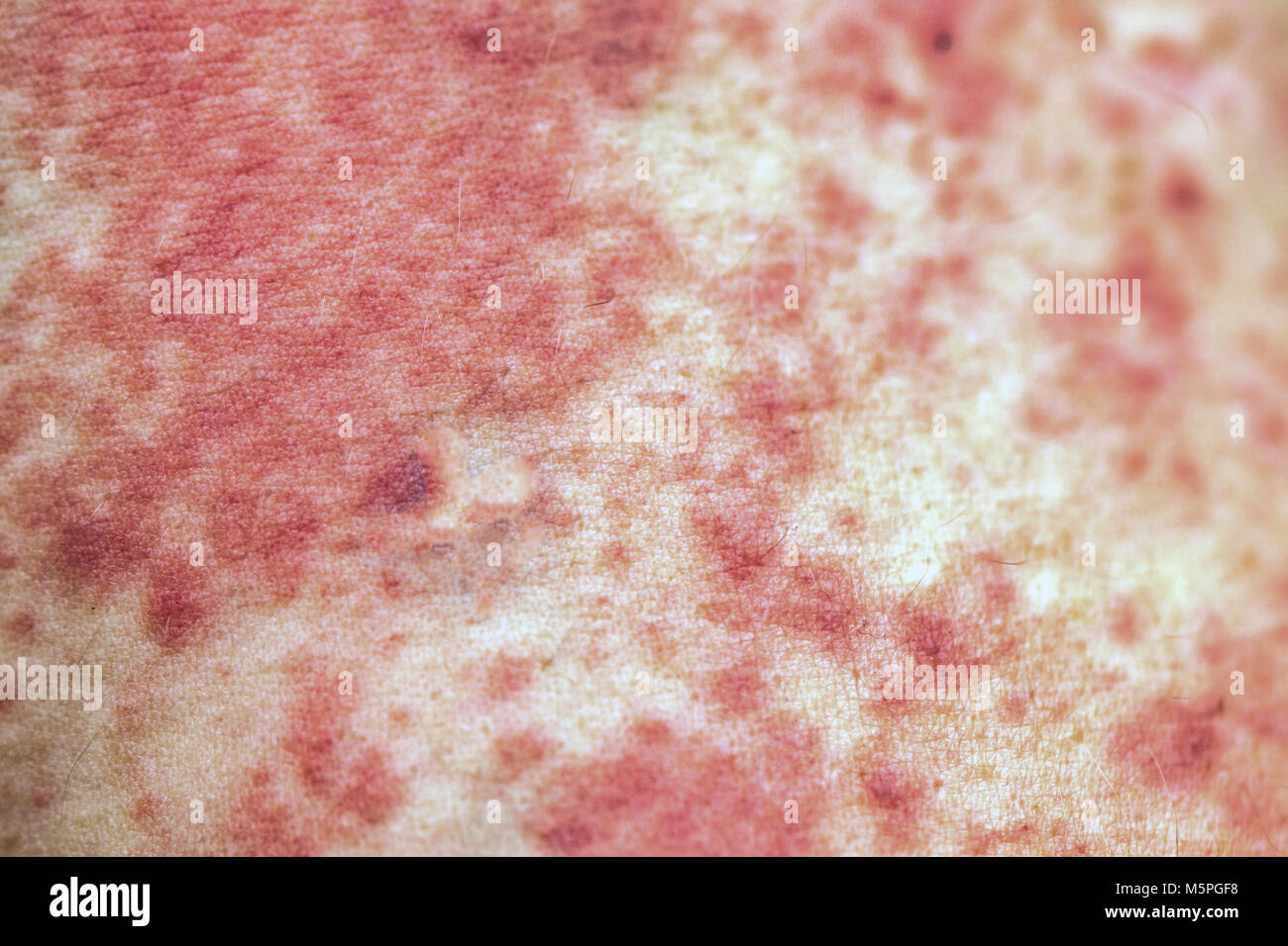 Eruzione cutanea immagini e fotografie stock ad alta risoluzione - Alamy