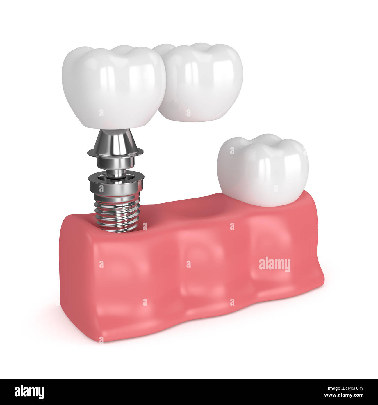 3D render di impianto dentale con ponte a sbalzo e denti sani nelle ...