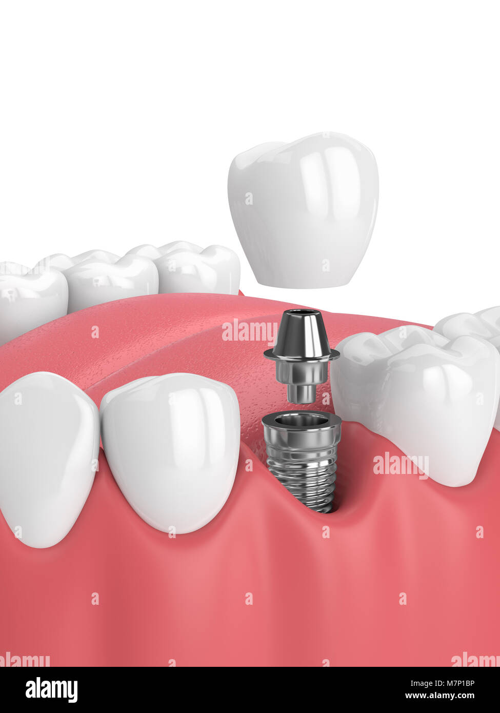 3D render della ganascia con denti e premolare dentale impianto su ...