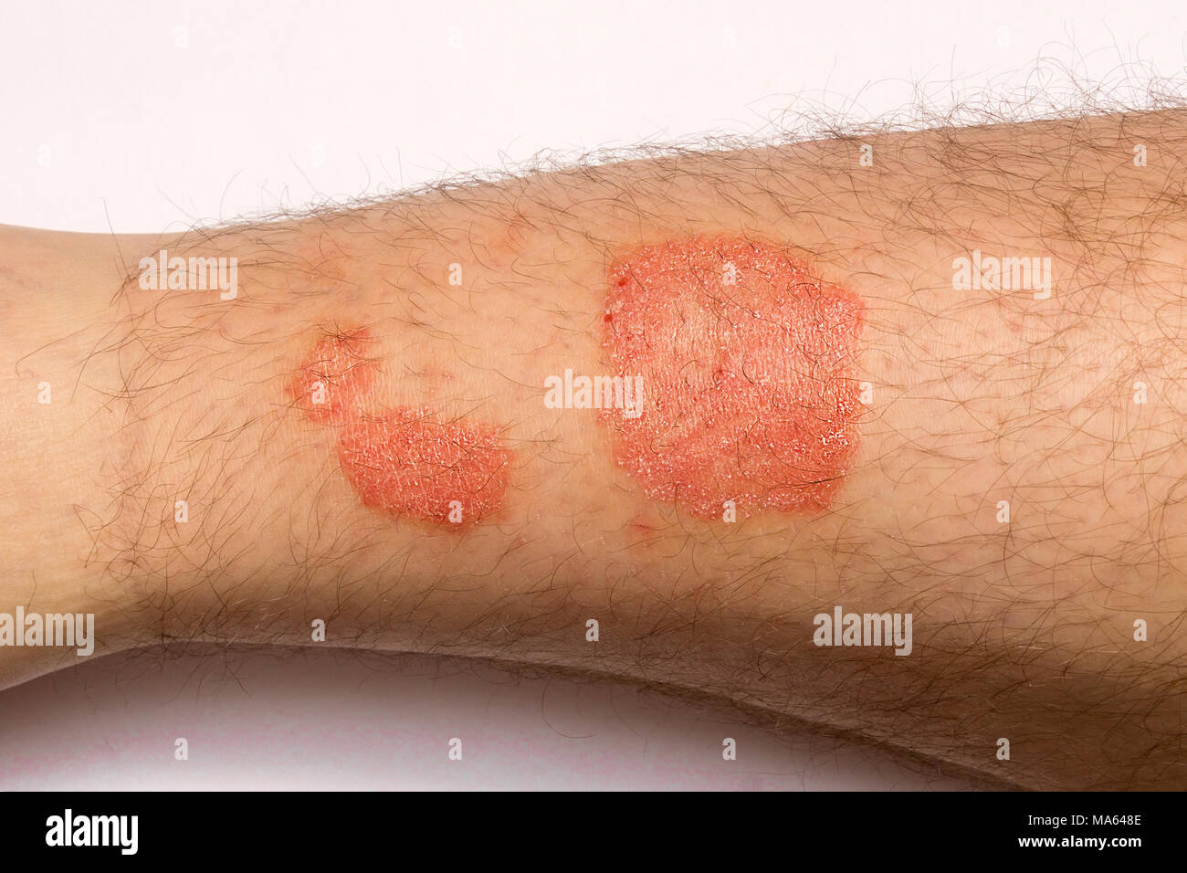 Eruzioni cutanee immagini e fotografie stock ad alta risoluzione - Alamy