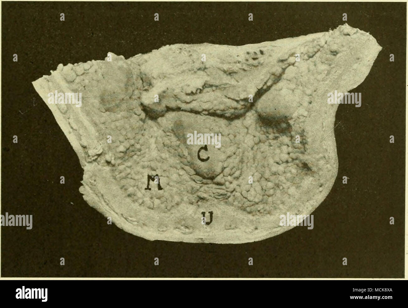 . Fig. 184-Pyometra con mucosa granulare. U, parete uterina ; M, mucosa ...