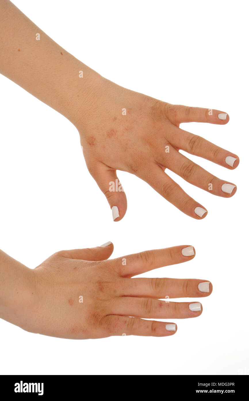 Dermatite alle mani immagini e fotografie stock ad alta risoluzione - Alamy