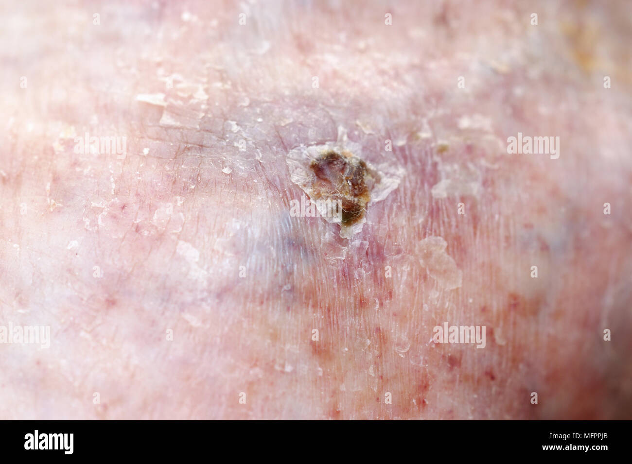 Ulcera varicosa1 immagini e fotografie stock ad alta risoluzione - Alamy