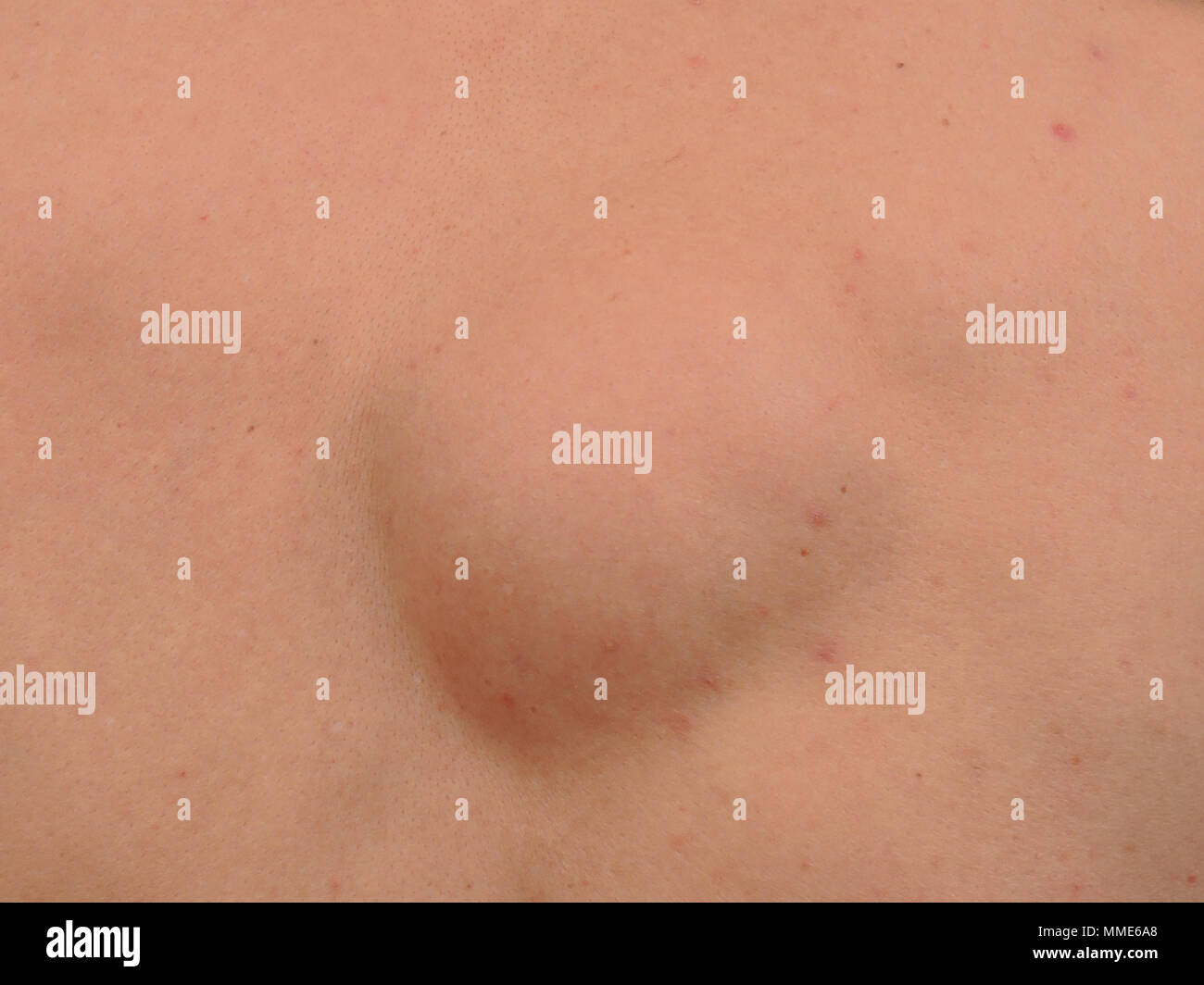 Lipoma tumour tumor immagini e fotografie stock ad alta risoluzione - Alamy