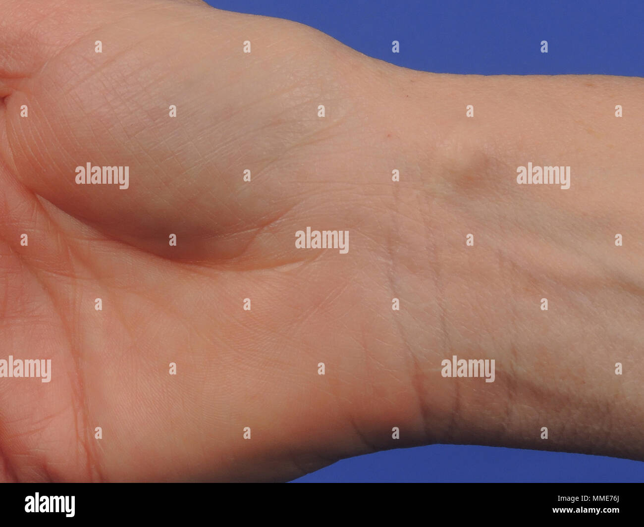 Synovial cyst immagini e fotografie stock ad alta risoluzione - Alamy