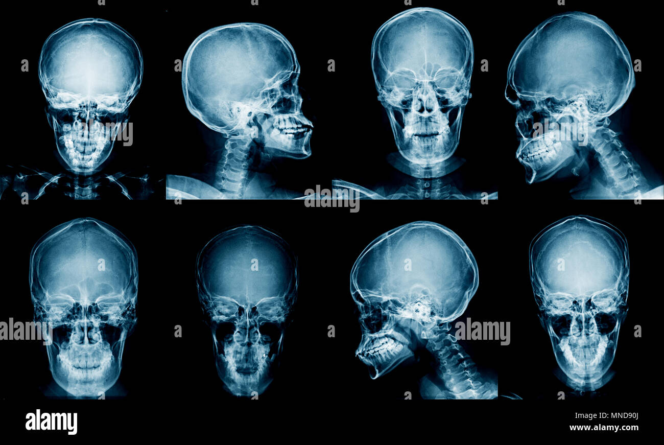 Cranio x ray immagini e fotografie stock ad alta risoluzione - Alamy