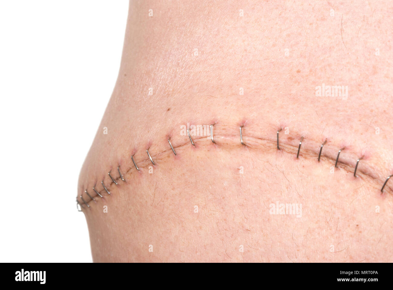 Incisione cutanea immagini e fotografie stock ad alta risoluzione - Alamy