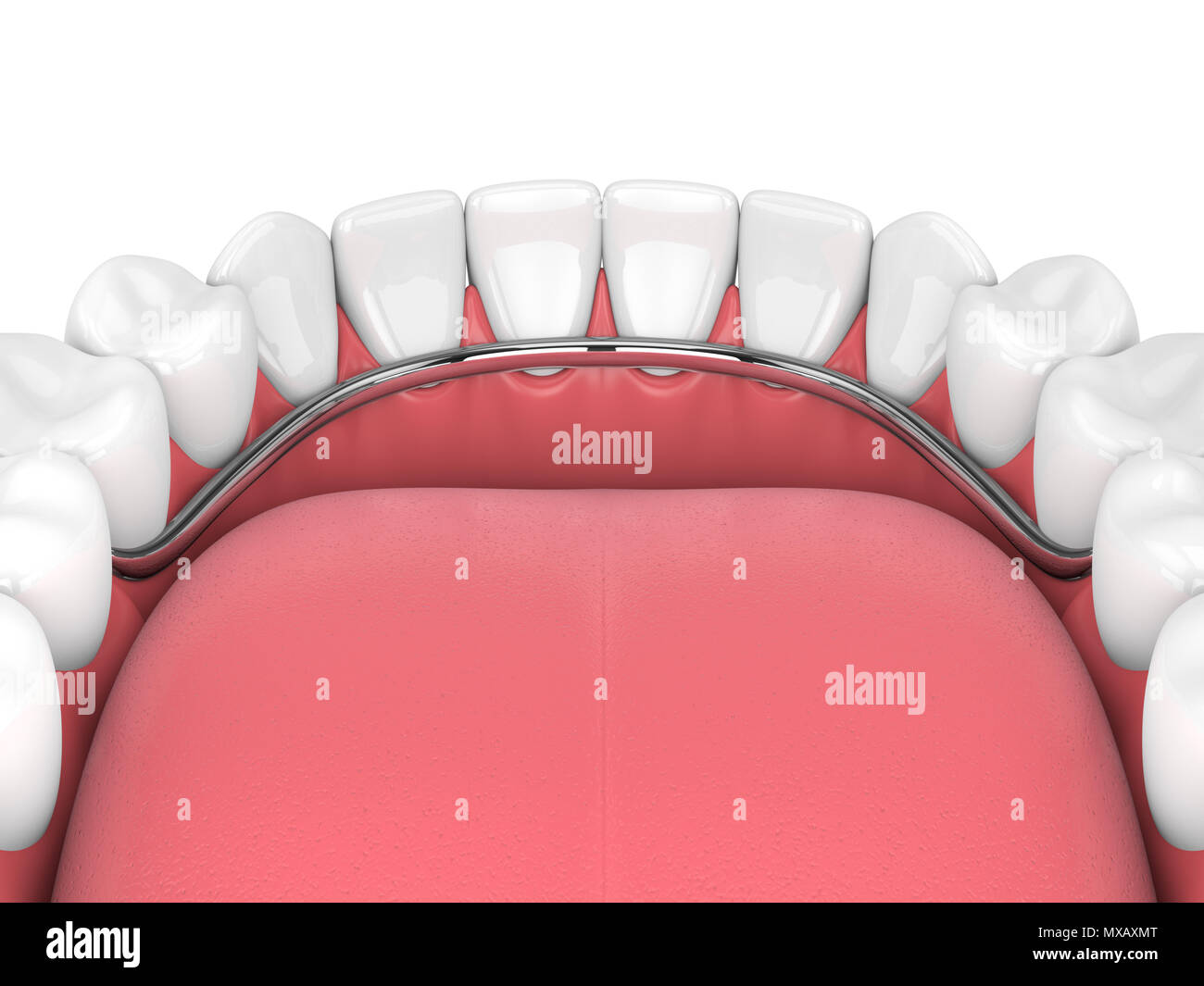 Protesi parziale rimovibile immagini e fotografie stock ad alta ...