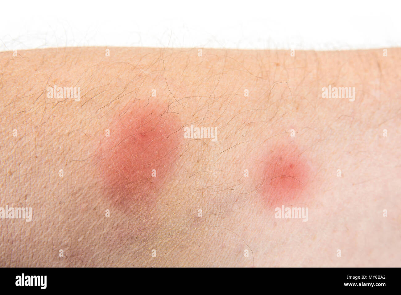 Punture di insetto sul corpo maschio. Cimici o flea Foto stock - Alamy