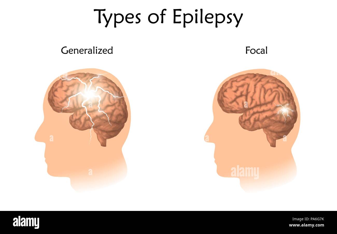 Tipi di epilessia immagini e fotografie stock ad alta risoluzione - Alamy