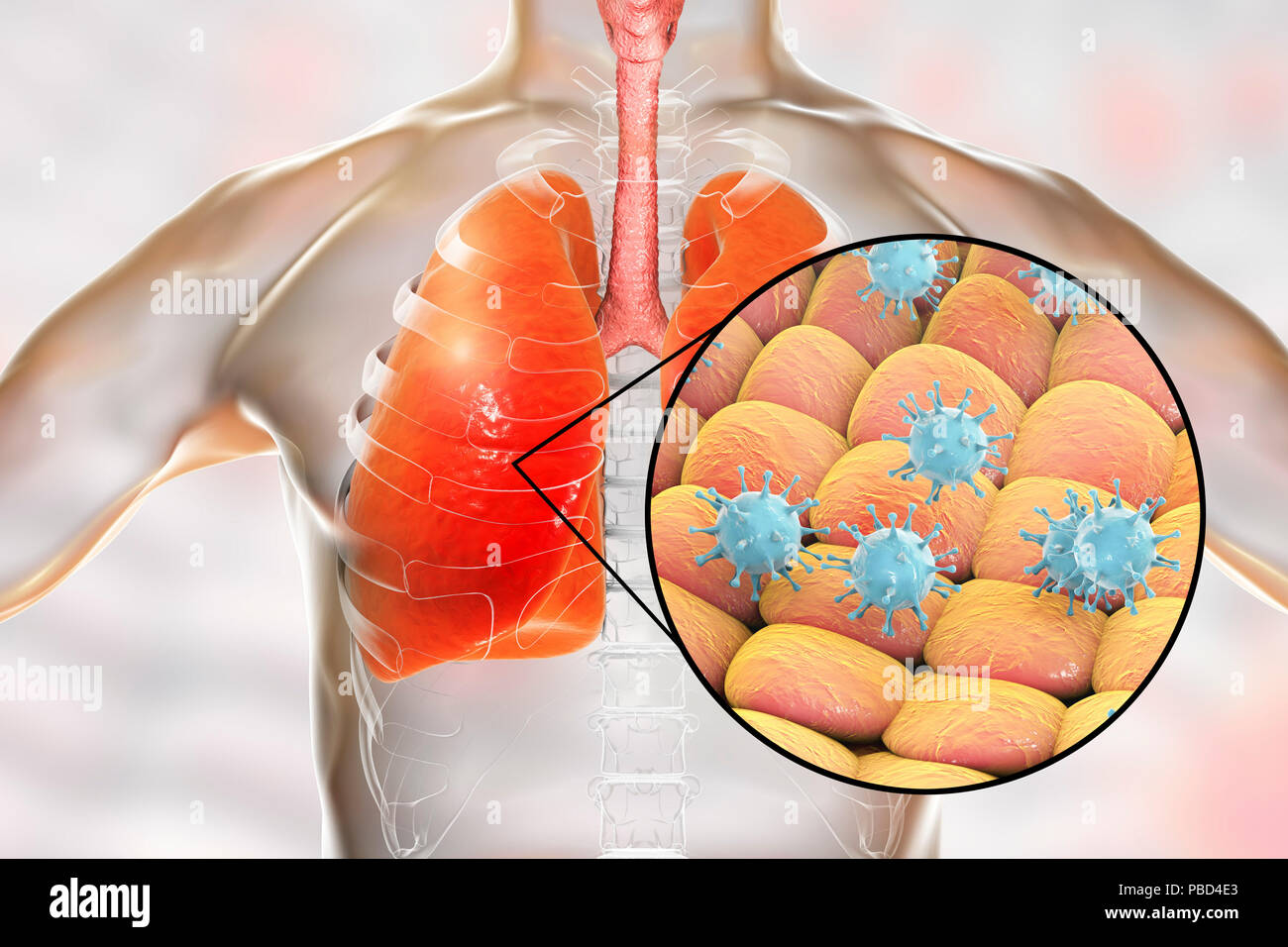 La polmonite virale, illustrazione concettuale. Polmoni umani e vista ...