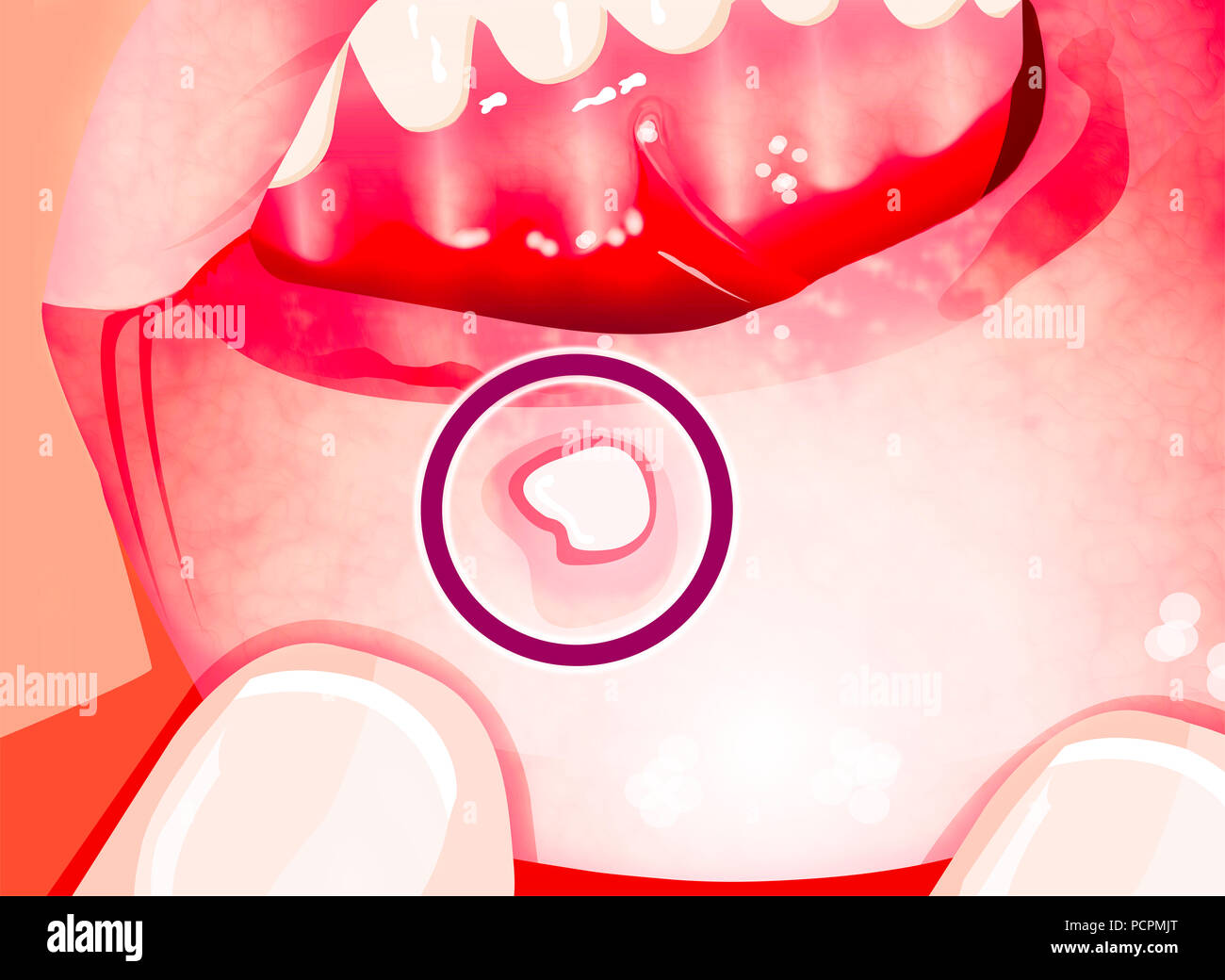 Ulcera aftosa orale immagini e fotografie stock ad alta risoluzione - Alamy