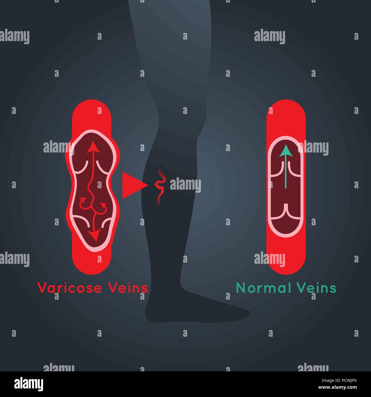 Varicose veins illustration immagini e fotografie stock ad alta ...