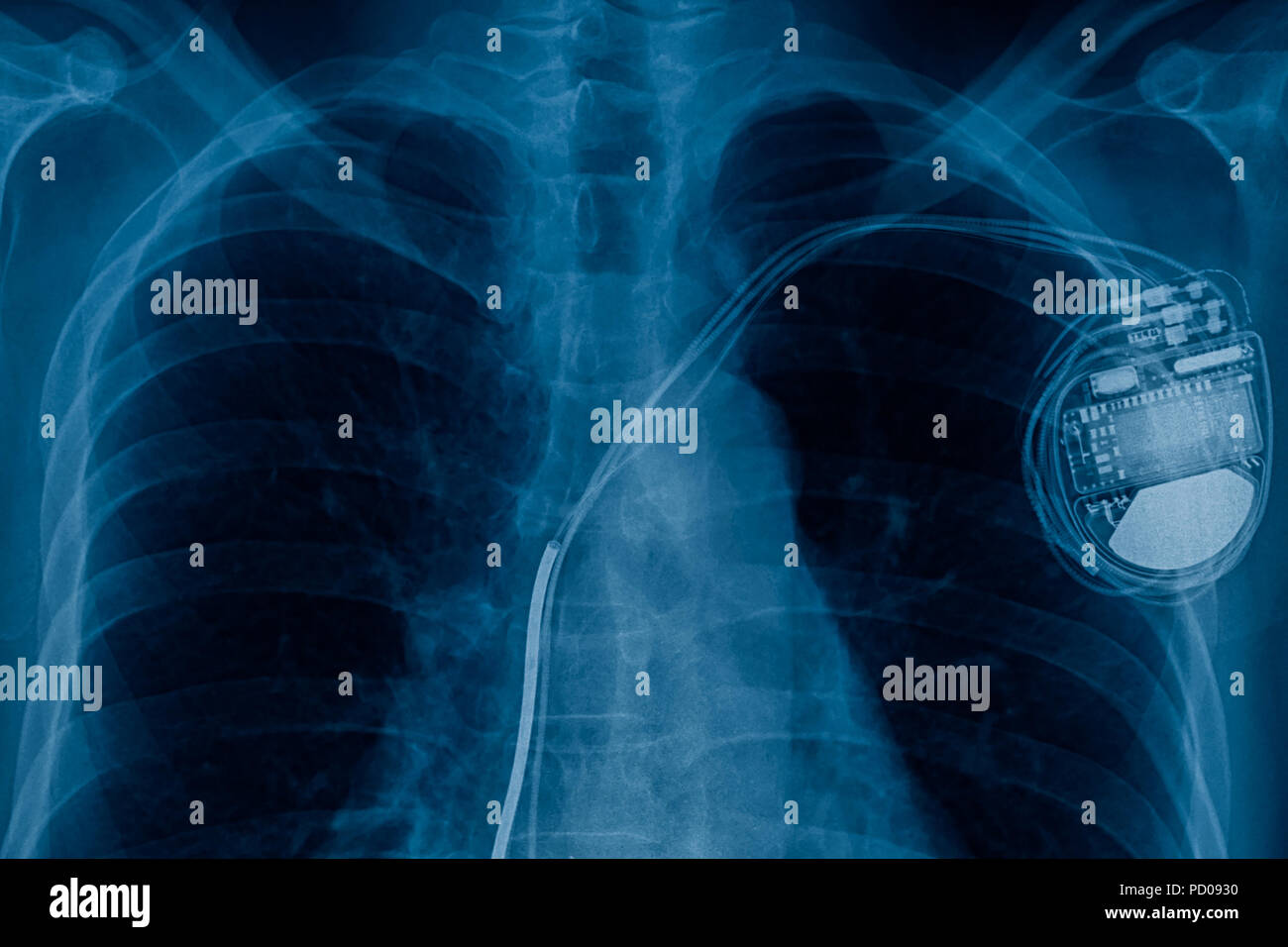 Radiografia del pacemaker immagini e fotografie stock ad alta ...