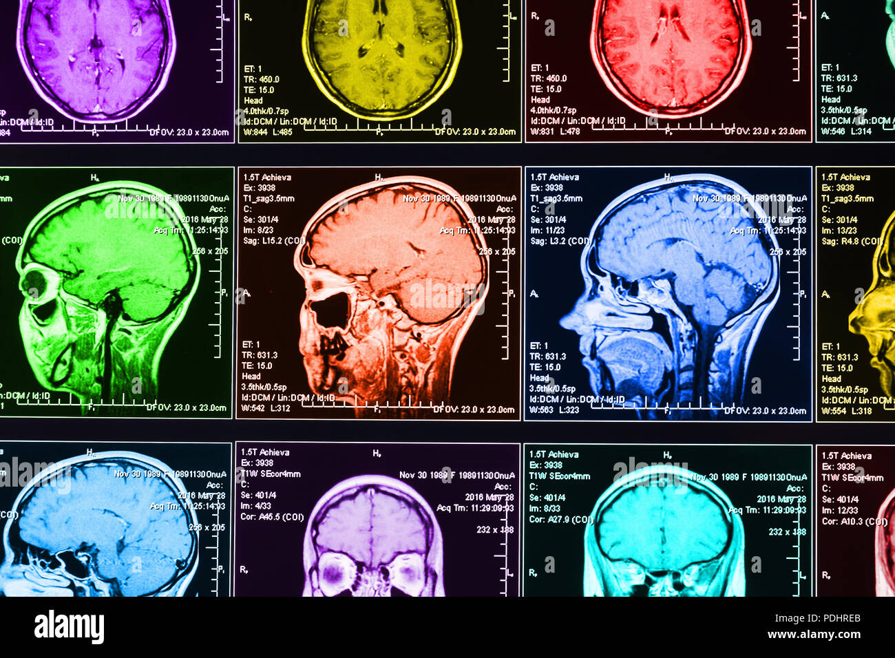 La risonanza magnetica la scansione del cervello. Testa di MRI scan ...