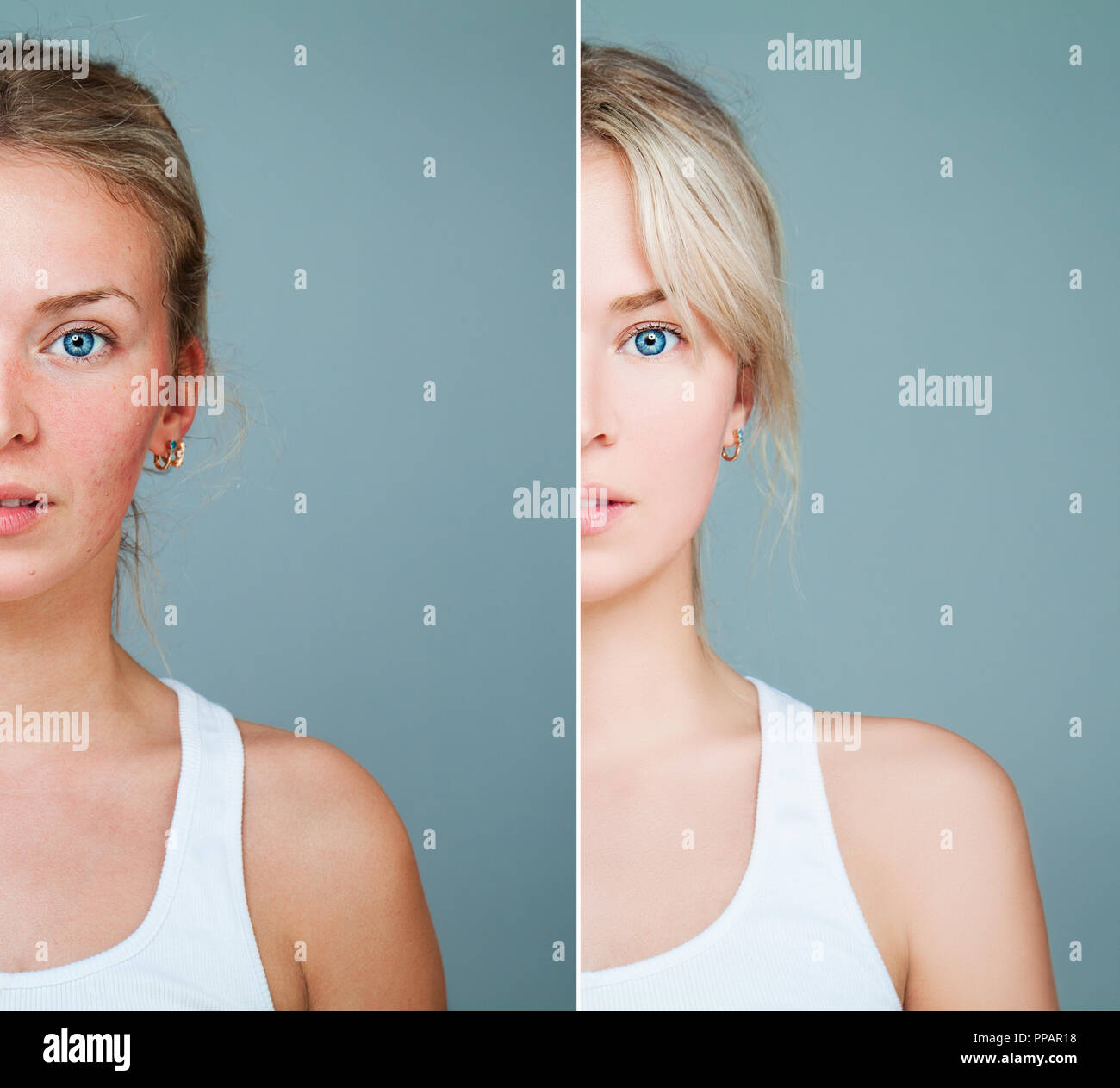 Pelle malsana immagini e fotografie stock ad alta risoluzione - Alamy