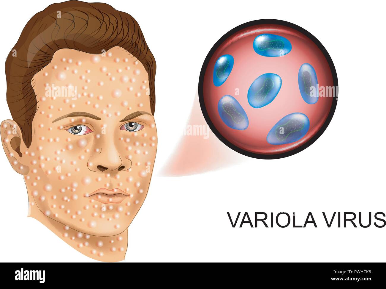 Virus del vaiolo immagini e fotografie stock ad alta risoluzione - Alamy