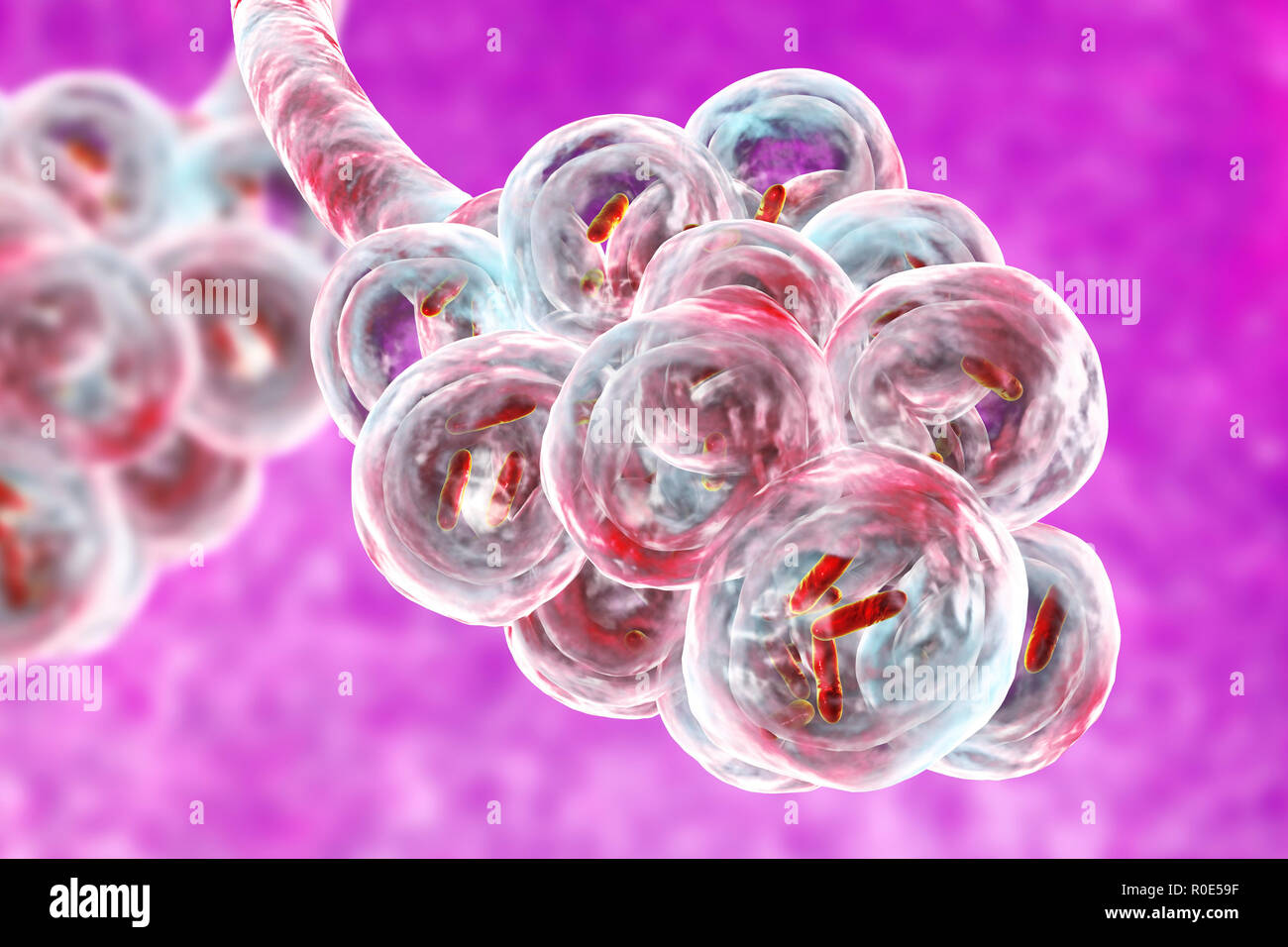 Una polmonite batterica. Computer illustrazione di a forma di asta ...