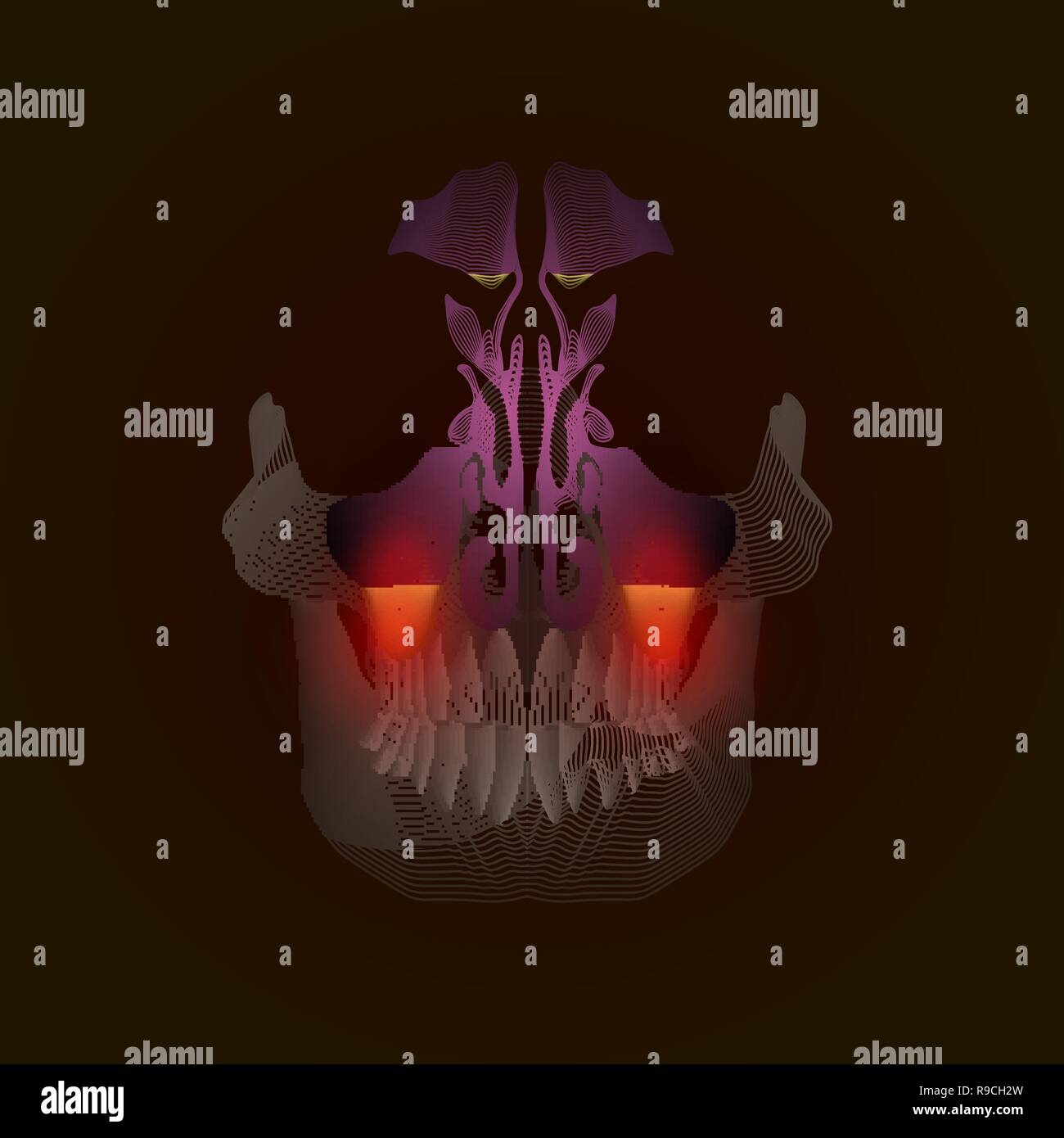 Illustrazione medica delle linee. Odontogenic sinusite. Infiammazione ...