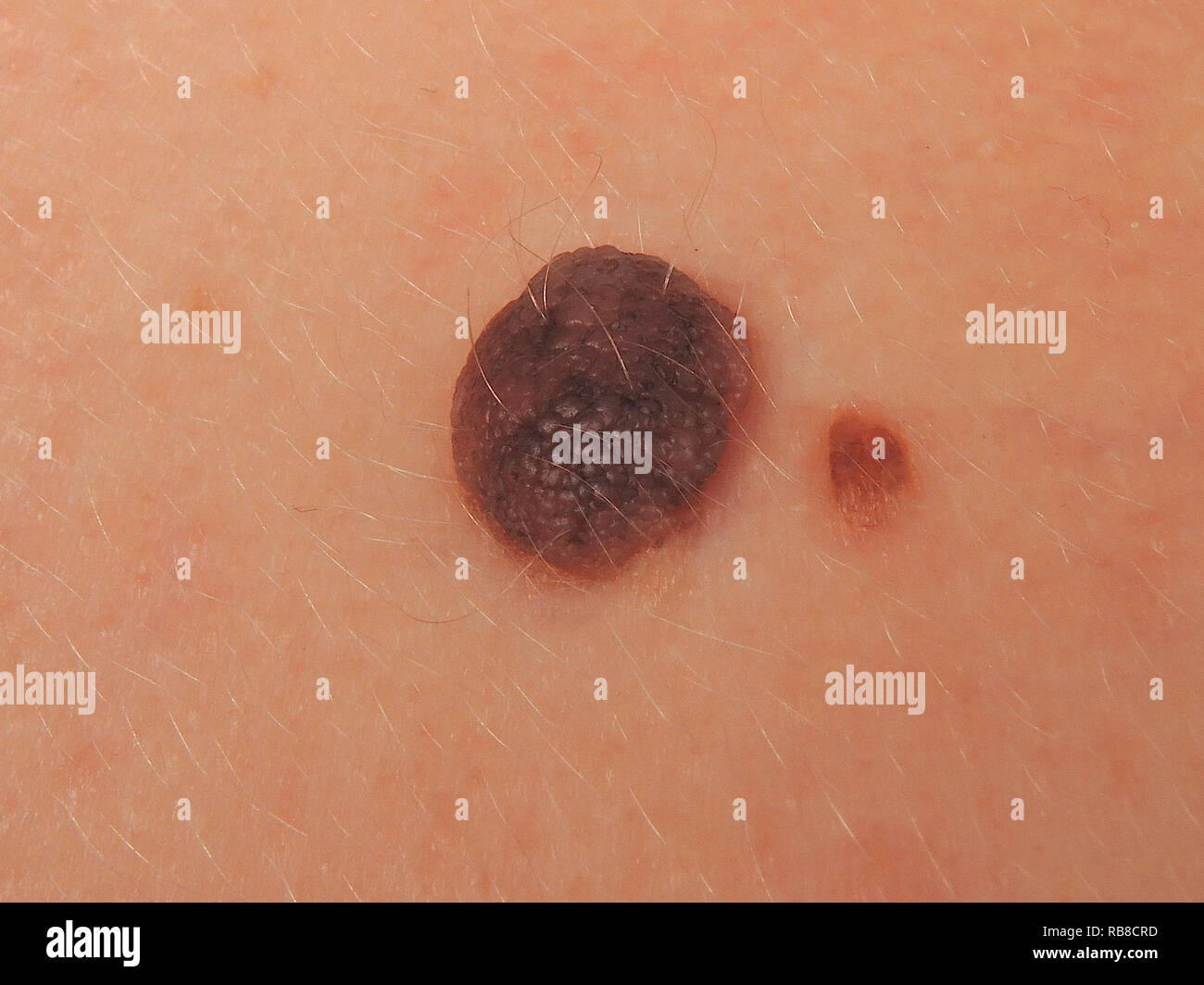 Naevus intradermico immagini e fotografie stock ad alta risoluzione - Alamy