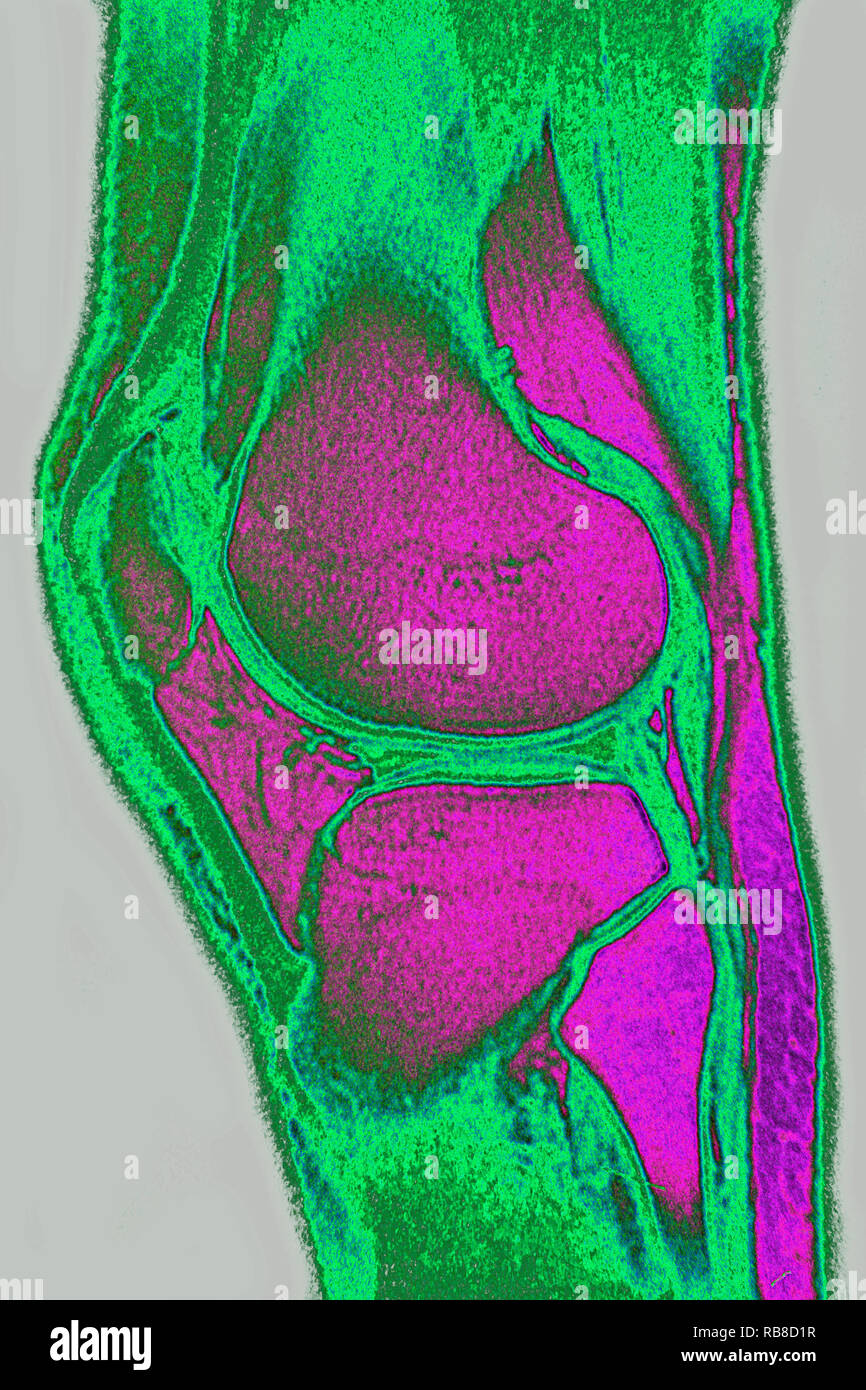 Mri di ginocchio immagini e fotografie stock ad alta risoluzione - Alamy