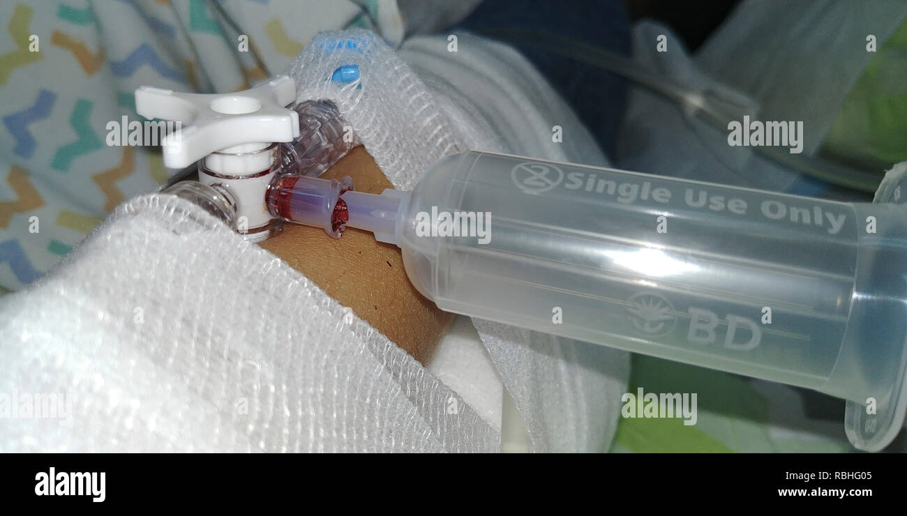 Flebo Di Infusione Immagini e Fotos Stock - Alamy