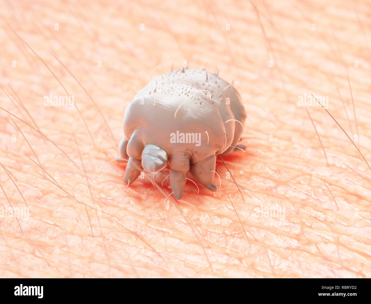 Scabies mites immagini e fotografie stock ad alta risoluzione - Alamy