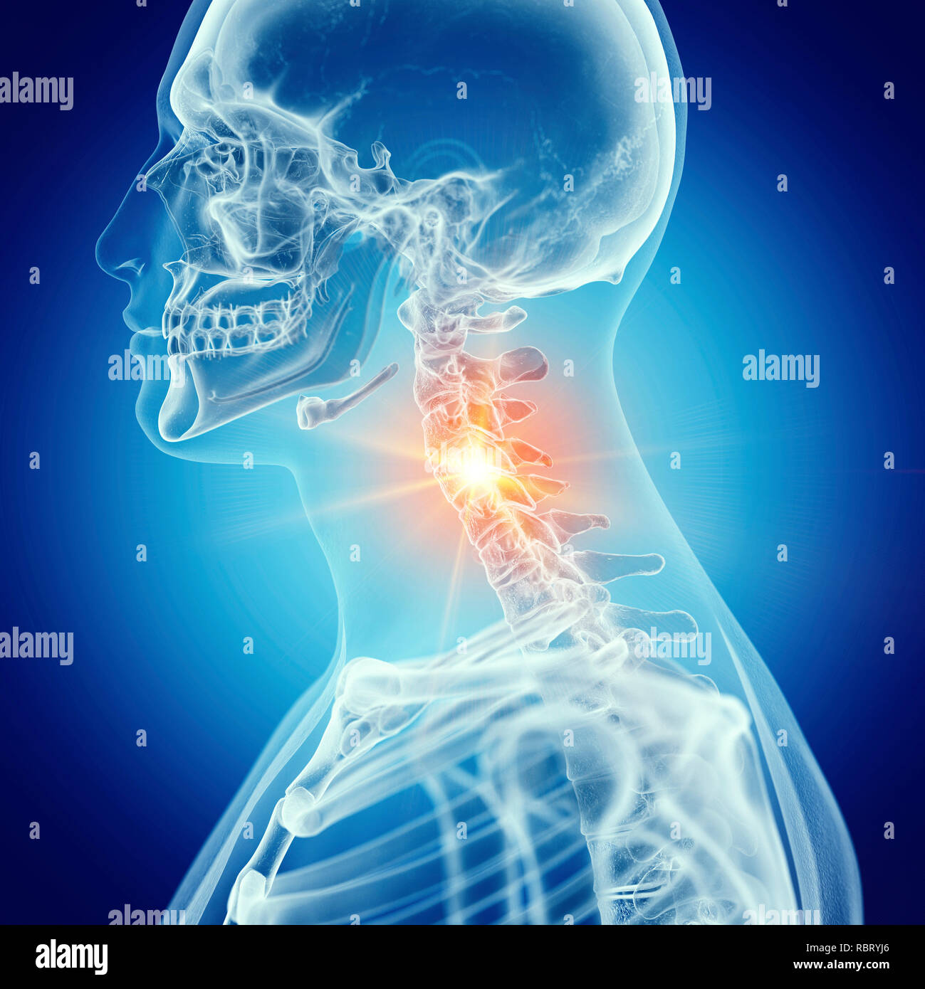Artrosi cervicale immagini e fotografie stock ad alta risoluzione - Alamy