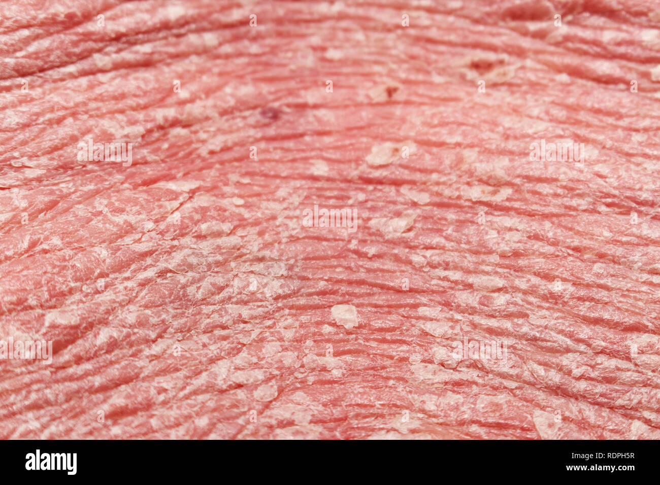 Psoriasi Della Malattia Immagini e Fotos Stock - Alamy