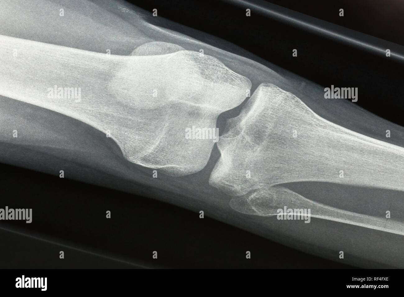 Tibia perone immagini e fotografie stock ad alta risoluzione - Alamy